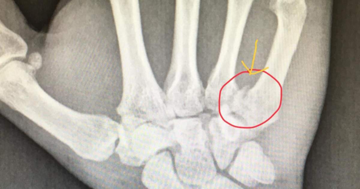 Dominik Vincon: Endurance trotz Knochenbruch - Endurance-WM - SPEEDWEEK.com